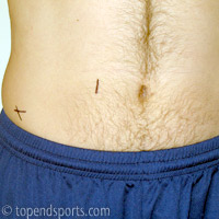 Abdominal Skinfold Site